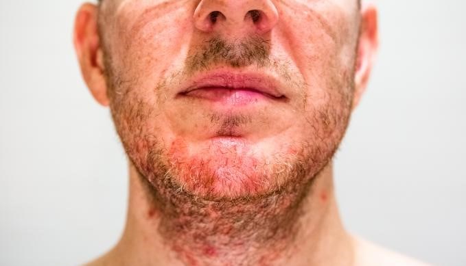 3 Types of Dermatitis and How to Treat Them SweetCare