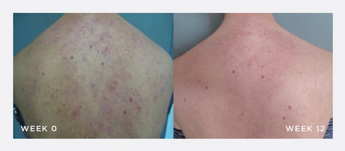 Acne-prone skin? biretix is the solution! | SweetMag - Consejos y guías ...