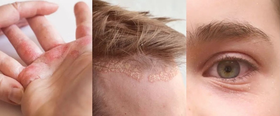 3 Types of Dermatitis and How to Treat Them - SweetCare Saint Barthelemy