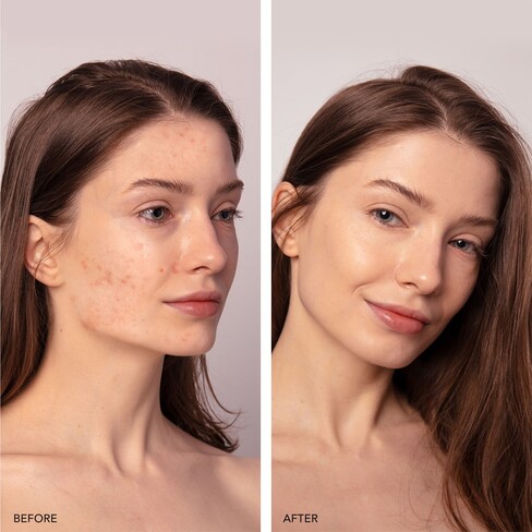 Foreo Espada™ 2 Plus Precise Targeting Blue Led Light Acne Treatment ...