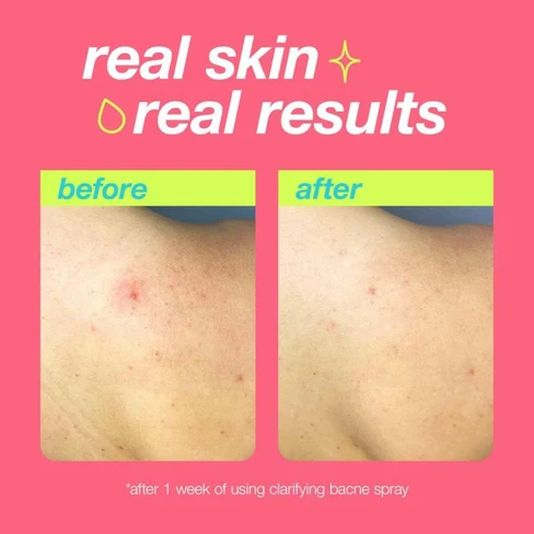 Dermalogica Clear Start Spray para Acne nas Costas Trata e Previne ...