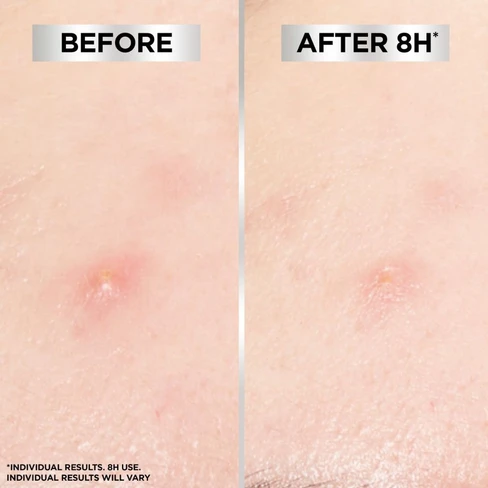 Garnier Pure Active Pimple Patch Invisible Reduces Pimples in 8 Hours ...